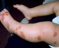 what is vasculitis - Pediatric Center